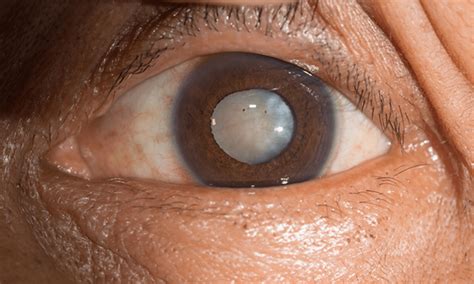 Cataract Symptoms And Treatment Doctor Eye Institute
