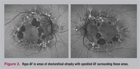 Masquerading Maculopathy The Importance Of Correct Diagnosis