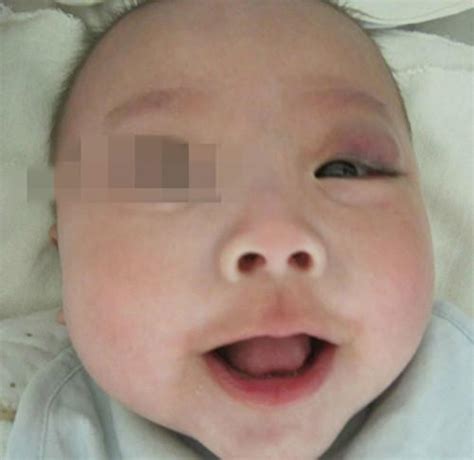 眼部血管瘤危險嗎？附眼部血管瘤常見類型和治療方法 每日頭條