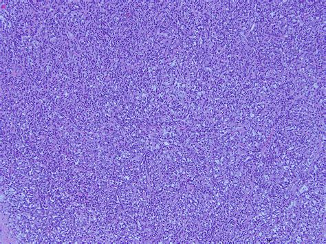 Lymphoma Of Thyroid Gland