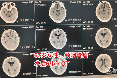 夹缝中取瘤and今年的第171例颅咽管瘤（2023年） 脑医汇