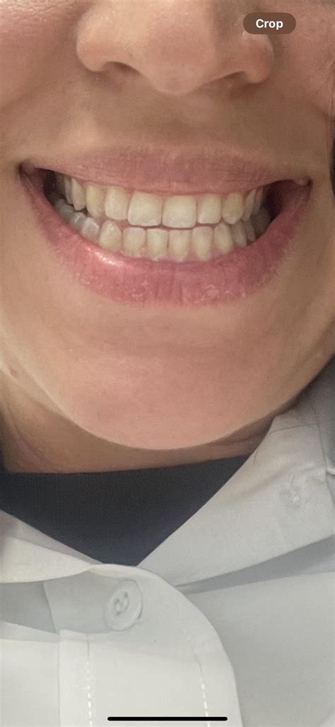 Braces Progress Scrolller