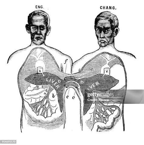 Hensel Twins Anatomy