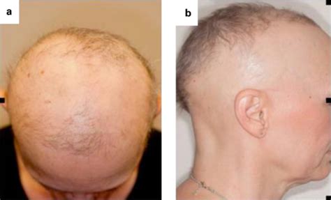 The Patient Presents With The Loss Of Hair On Her Scalp After Initial