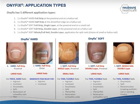 How To Fix Pincer Nails Nail Ftempo