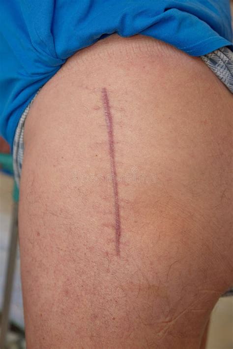 One Year Old Scar After Hip Replacement Surgery Stock Image Image Of