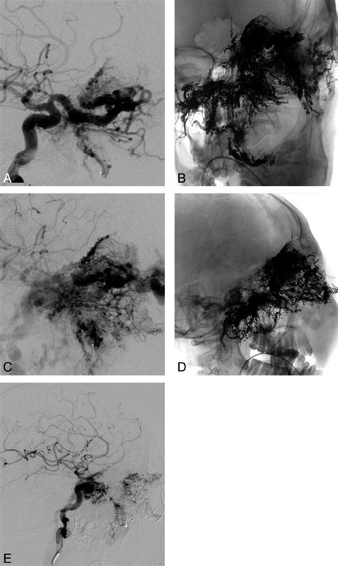 Safety And Clinical Efficacy Of Onyx For Embolization Of Extracranial Head And Neck Vascular