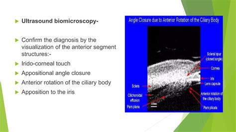 Neovascular Glaucoma Nvg Pptx