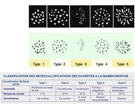 Diagnostic Des Calcifications Mammaires Dr Kara Zaitri Ma