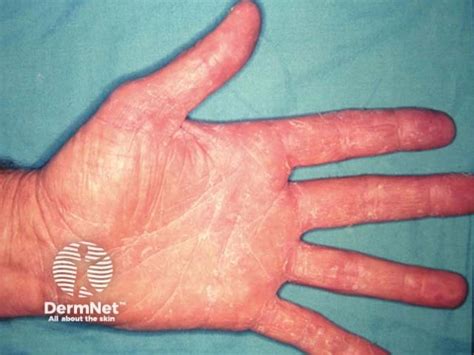 Eczema Or Hand Fungus Photos Symptoms And Treatment Differences