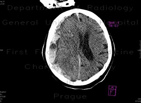 Radiology Case Acute Subdural Hemorrhage Active Bleeding Subfalcine