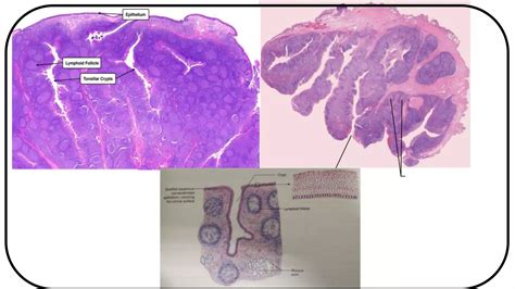 Acute And Chronic Tonsillitis Pptx