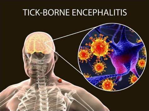 Tick Borne Encephalitis Treatment In Ayurveda