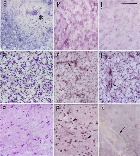 Trk Receptor Immunoreactivity In Different Samples Of Astrocytomas And