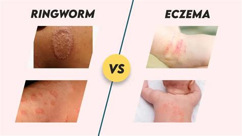 Ringworm Vs Eczema What Are The Differences Happy Cappy