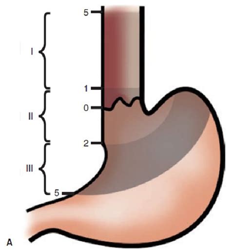 Clasificación Del Adenocarcinoma En La Unión Esofagogástrica Siewert
