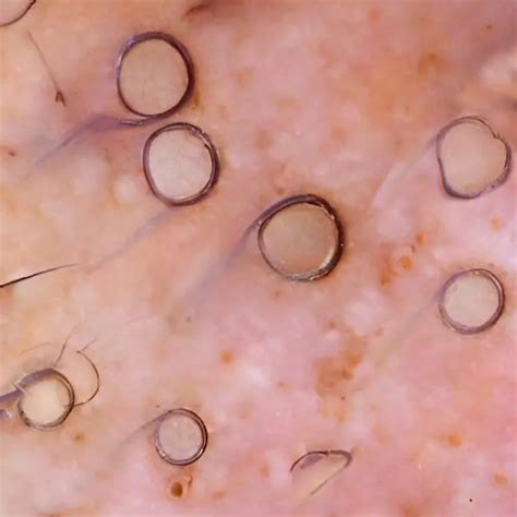 Pili Multigemini Multiple Hairs Growing From A Single Hair Canal