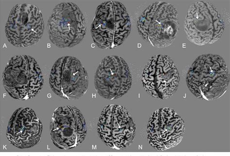 Figure 1 From Navigated Transcranial Magnetic Stimulation For Glioma Removal Prognostic Value