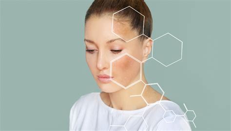 Sun Damage Hyperpigmentation Dermaskinshop Sg