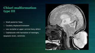 Congenital Brain Anomalies For Radiology Pptx