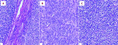 Type Ab Thymoma A Classical Biphasic Tumor With Delineation Of A