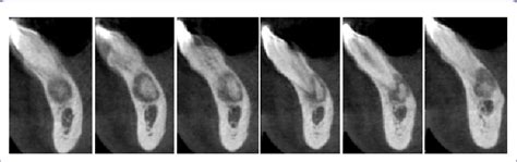 Note The Intimate Relationship Of The Lesion With The 13 Apical Part