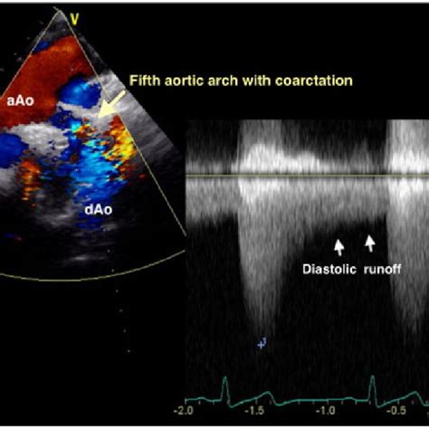 Suprasternal View In Transthoracic Echocardiography Showing Flow Download Scientific Diagram