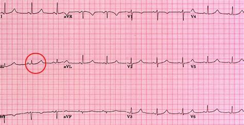 Step 10 Measure QT Interval For Specific Diagnoses