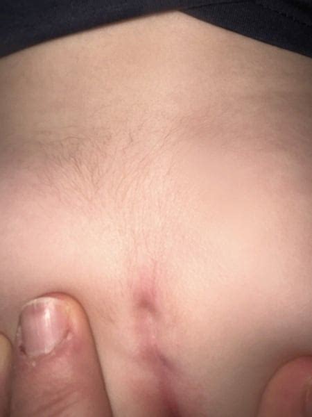 Sacral Dimple Pictures