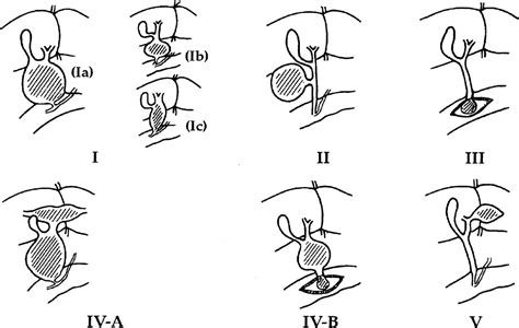 Classification Of Congenital Biliary Cystic Disease Special Reference