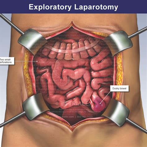 Medical Legal Exhibits Legal Animations And Trial Graphics Tria