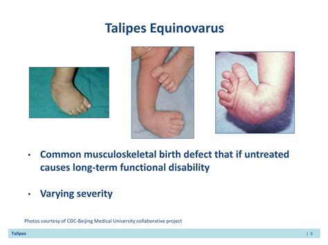 Idiopathic Talipes Equinovarus Congenital Clubfoot Pptx