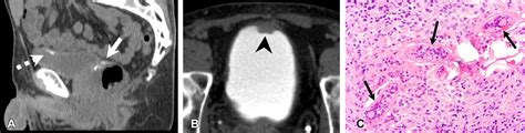 Urinary Bladder Masses Rare Subtypes And Masslike Lesions Radiologic Pathologic