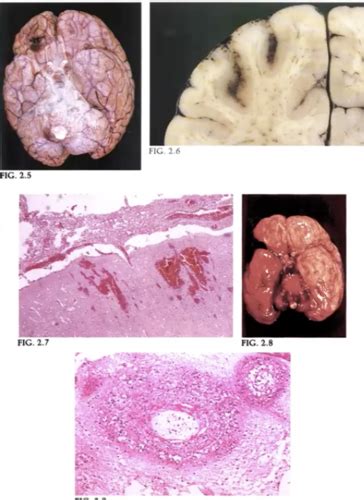Clinical Approach To Headache Meningitis Encaphalitis Flashcards