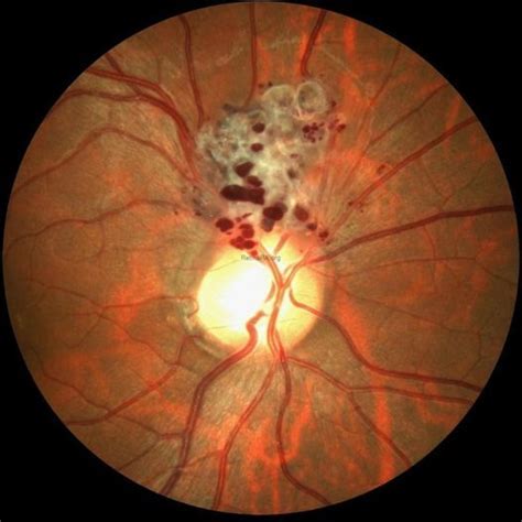 Zahra Medicare On Linkedin Retinal Cavernous Hemangioma Credit Retinaacademy