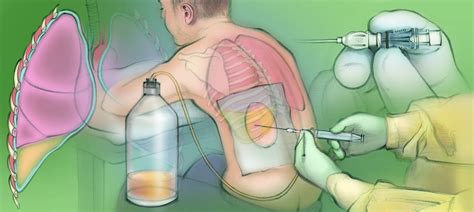 Thoracentesis