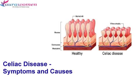 Celiac Disease Symptoms And Causes Aurawomen