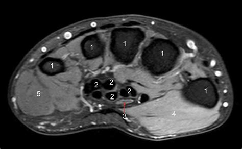Diagram Of Patient 2 Week 5 Axial L Wrist Quizlet