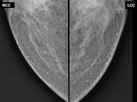 Atlas Of Breast Cancer Early Detection