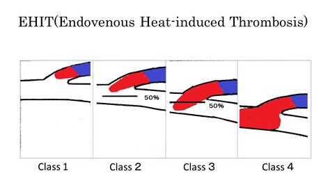 静脈瘤日帰りレーザー治療専門 こうち静脈ケアクリニック レーザー治療後の合併症 Ehit Endovenous Heat Induced