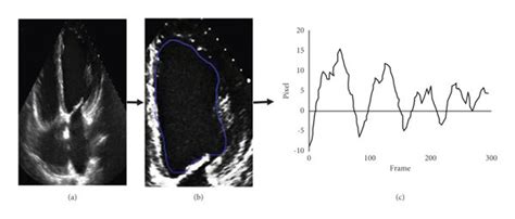 Ultrasonic Cardiogram Of A 45 Year Old Female Patient A The Original Download Scientific