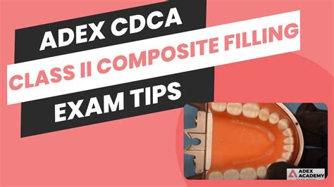 Adex Class Ii Complete Restoration Checklist Adex Cdca Dental Youtube