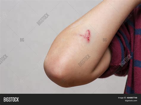 Scratches On Skin