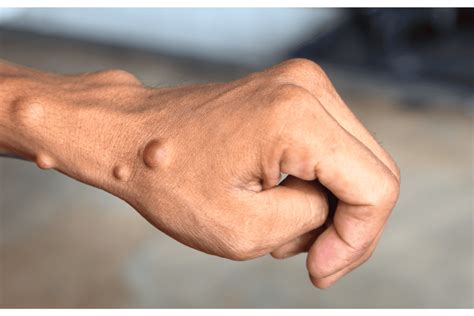 Neurofibromatosis Type 1 Causes Symptoms And Treatment