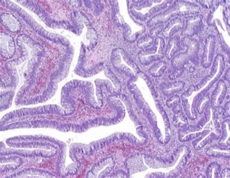 Histological Section From The Fragmented Polyp Showing An Adenoma With