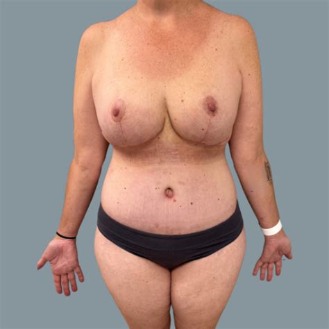 Circumferential Belt Lipectomy Body Lift The Coastal Clinic Plastic Surgery And Aesthetics