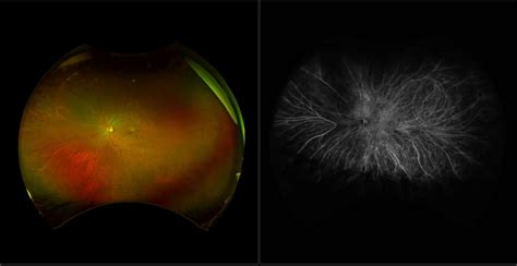 Branch Retinal Vein Occlusion Brvo