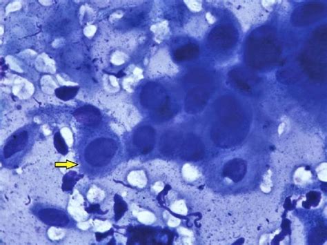 Teledermatology For Pg Entrance Acantholysis