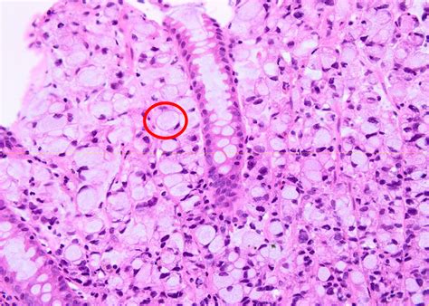 Primary Colorectal Linitis Plastica Presenting As Rapid Acute