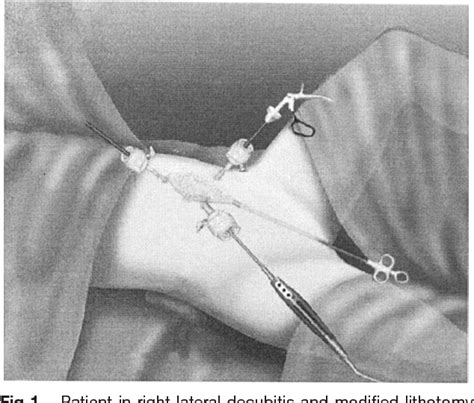 Figure 1 From Transvaginal Laparoscopic Donor Nephrectomy Semantic Scholar